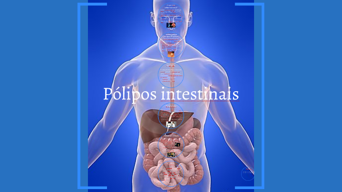 Pólipos intestinais by sofi rodrigues on Prezi