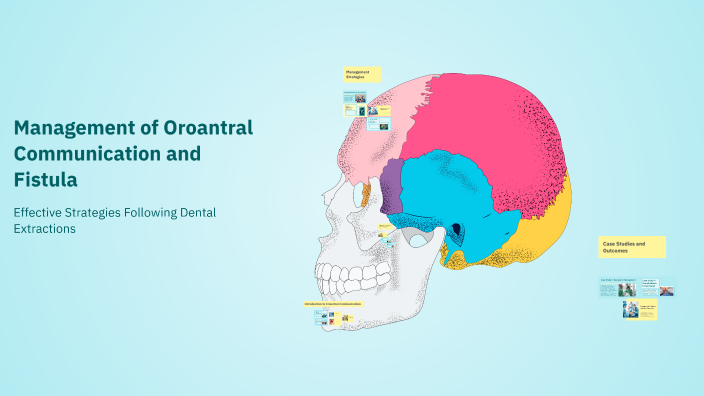 Management of Oroantral Communication and Fistula by Ahmed Elsefy on Prezi