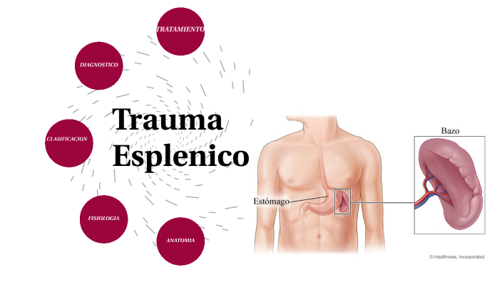 Trauma esplenico by Luis Ã ngel HernÃ¡ndez Tobar on Prezi