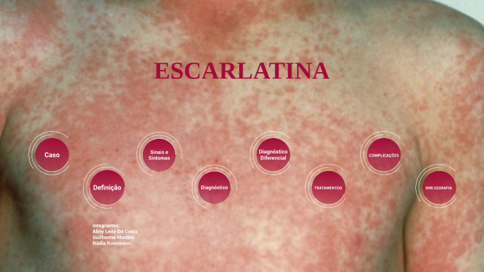 ESCARLATINA by Guilherme Martins on Prezi