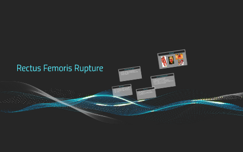 Rectus Femoris Rupture by Kathy Krase on Prezi