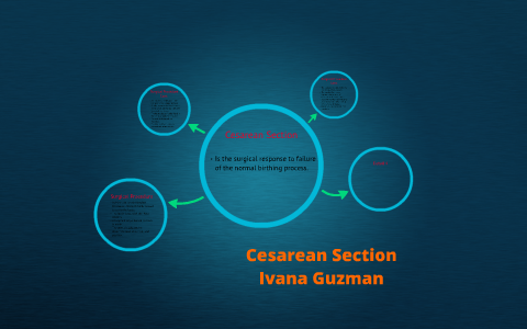 Cesarean Section by Ivana Guzman on Prezi