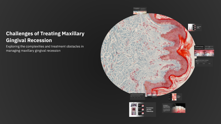 Challenges of Treating Maxillary Gingival Recession by Gitanjali P on Prezi