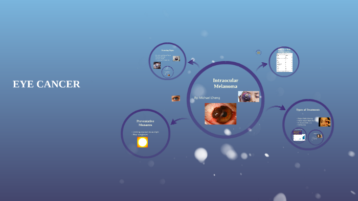 Intraocular melanoma by 114882 114882 on Prezi