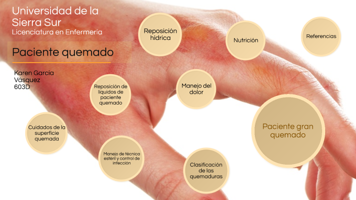Paciente quemado by Karen Ivanova on Prezi