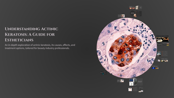 Understanding Actinic Keratosis: A Guide for Estheticians by Dayana De Jesus on Prezi
