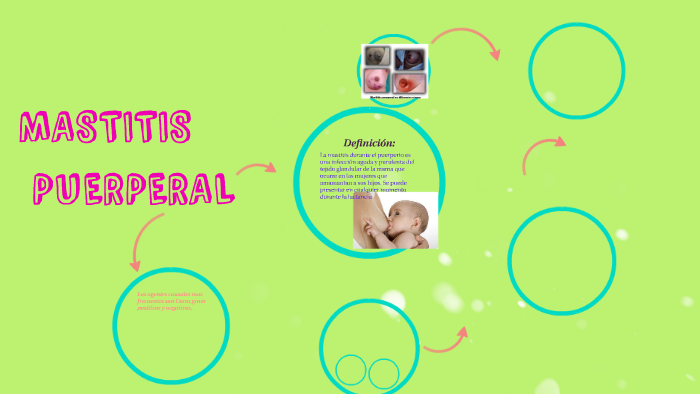 La mastitis durante el puerperio es una infección aguda y pu by ...