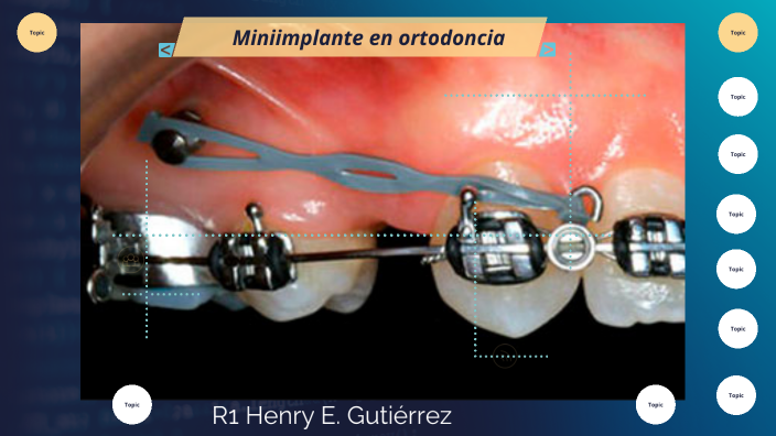 Mini Implante en ortodoncia by Henry Gutierrez on Prezi