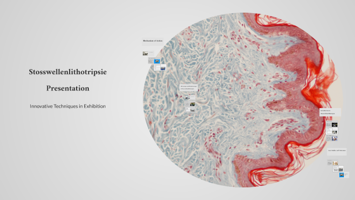Stosswellenlithotripsie Presentation by hossein mansouri on Prezi