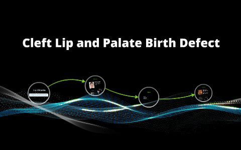 Cleft Lip and Cleft Palate Birth Defect by Edith Flores on Prezi