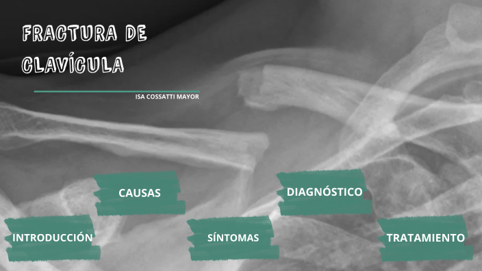 Presentacion anatomia: Rotura de clavicula by Isa Cossatti Mayor on Prezi