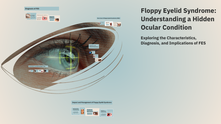 Floppy Eyelid Syndrome: Understanding a Hidden Ocular Condition by ...