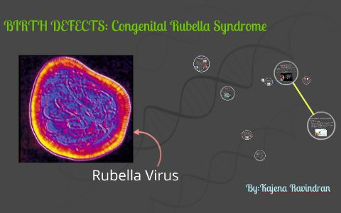 BIRTH DEFECTS: Congenital Rubella Syndrome by Kajena R on Prezi