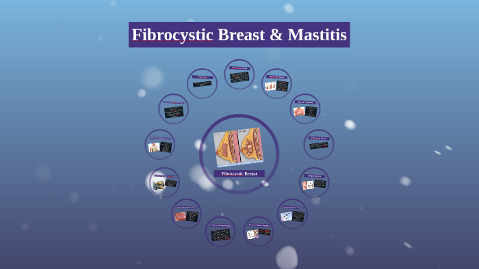 Fibrocystic Breast And Acute and Chronic Mastitis by elizabeth gamel on ...