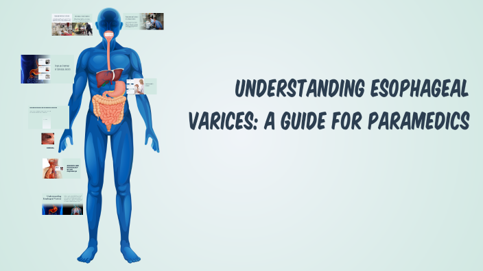 Understanding Esophageal Varices: A Guide for Paramedics by Chiefton ...