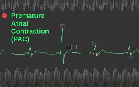 Premature Atrial Contraction (PAC) by Gillian Bushman on Prezi