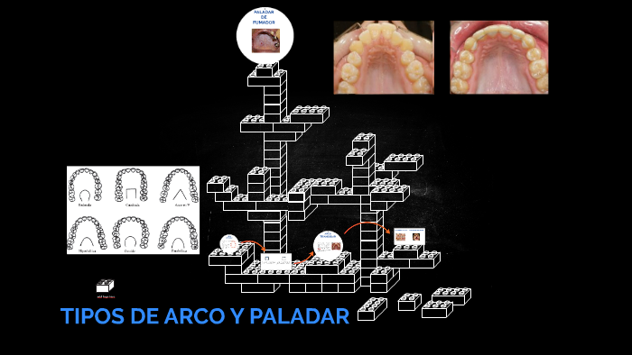 TIPOS DE PALADAR Y ARCO by karoll Nathalia vergel Lobaton on Prezi