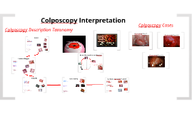 Basic Colposcopy Interpretation by Wendy Barr on Prezi